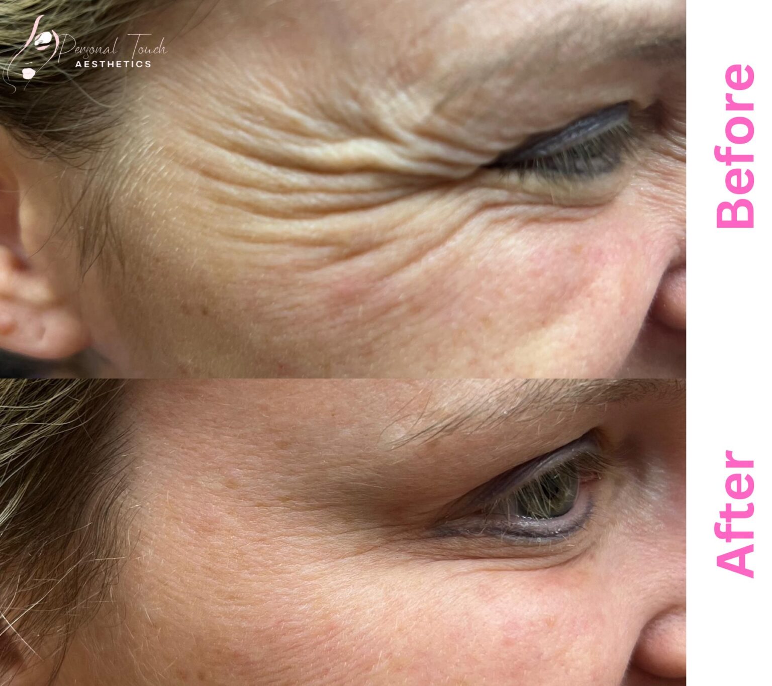 Dysport Before And After Picture in Tucson, AZ | Book Now