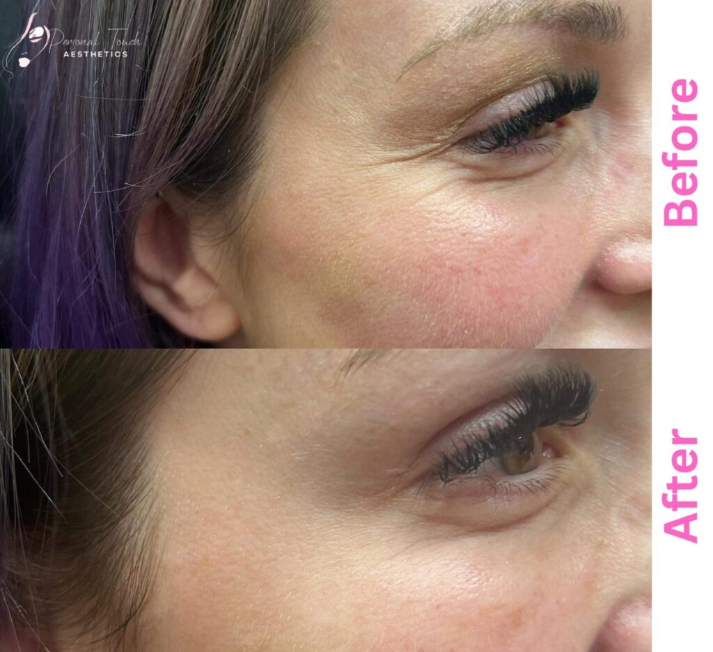 Botox Before And After Picture | Tucson, AZ