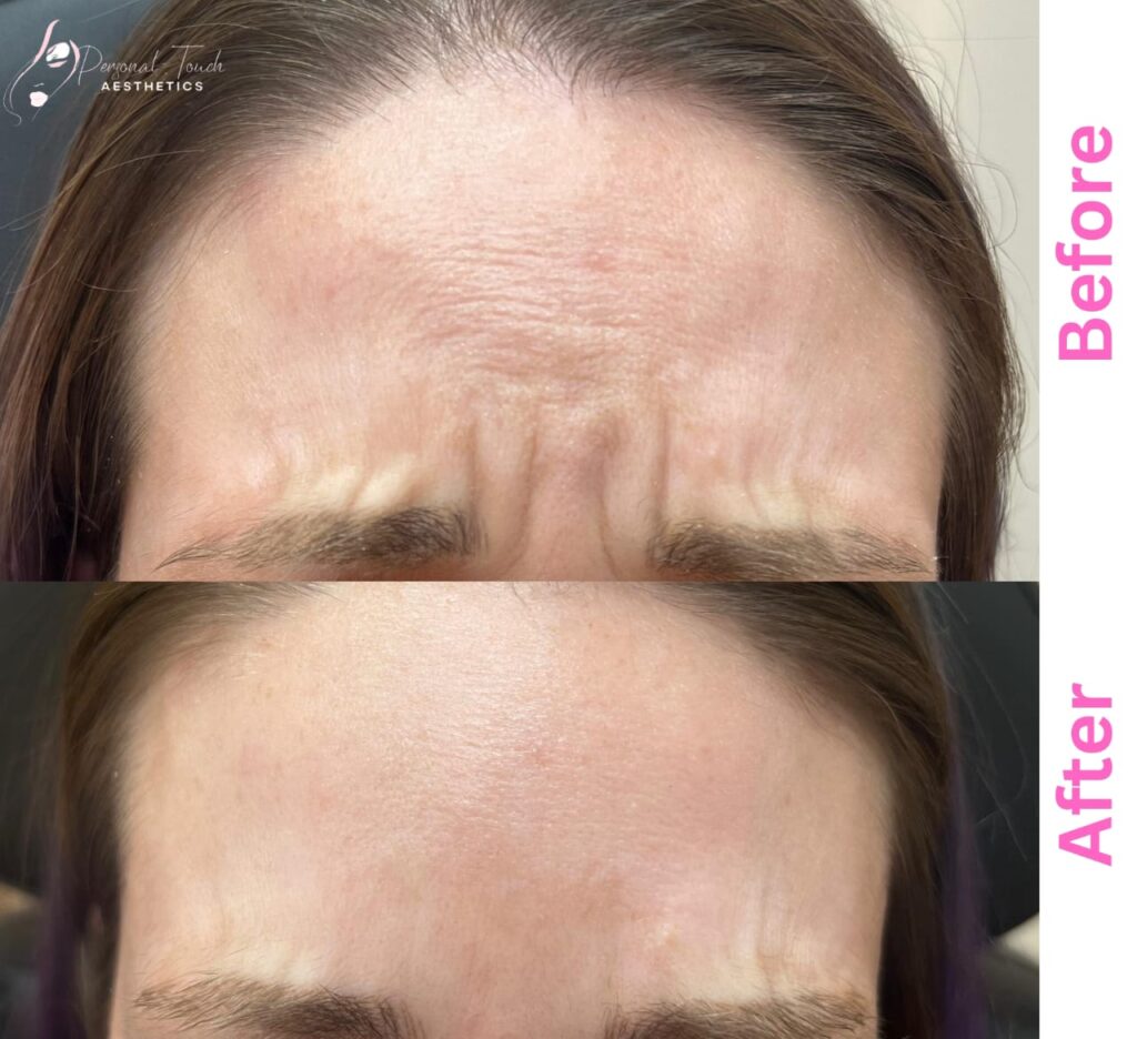 Botox Before And After Picture | Tucson, AZ